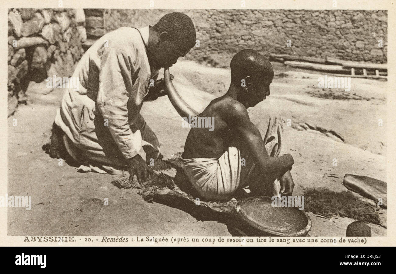 Il salasso immagini e fotografie stock ad alta risoluzione - Alamy