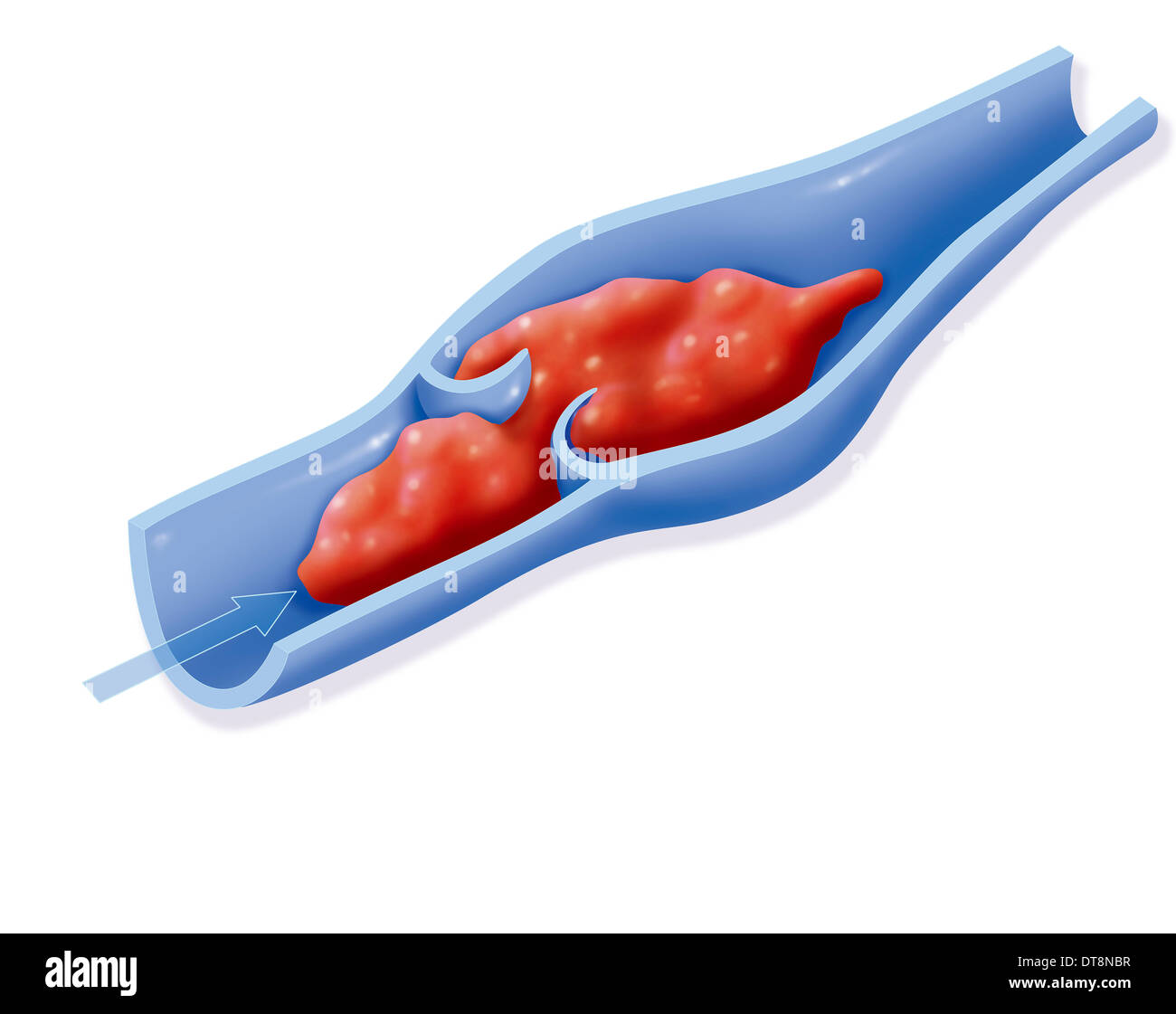 Tromboembolismo Venoso Immagini e Fotos Stock - Alamy