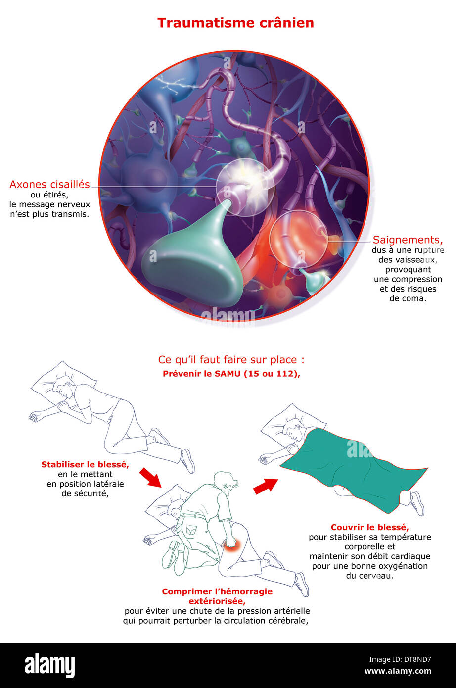 Lesioni neurologiche immagini e fotografie stock ad alta risoluzione ...