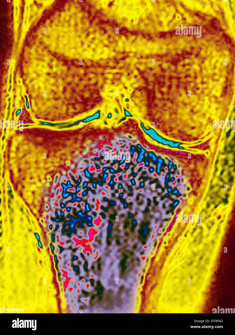 Osteosarcoma maligno immagini e fotografie stock ad alta risoluzione ...