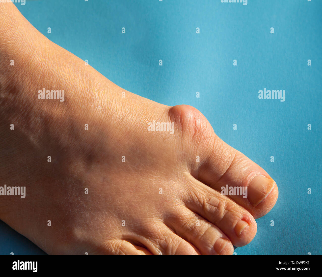 Donna con alluce valgo immagini e fotografie stock ad alta risoluzione ...