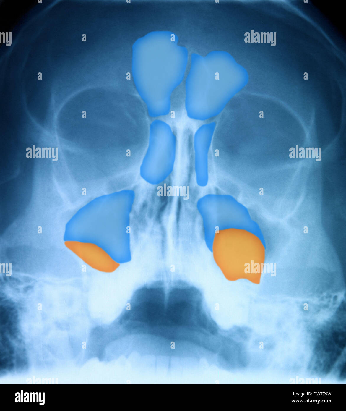 Seno sfenoidale immagini e fotografie stock ad alta risoluzione - Alamy