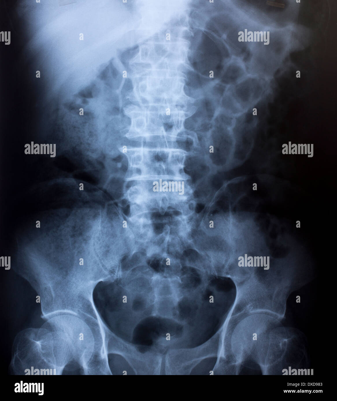 Dove ottenere una radiografia del torace immagini e fotografie stock ad ...