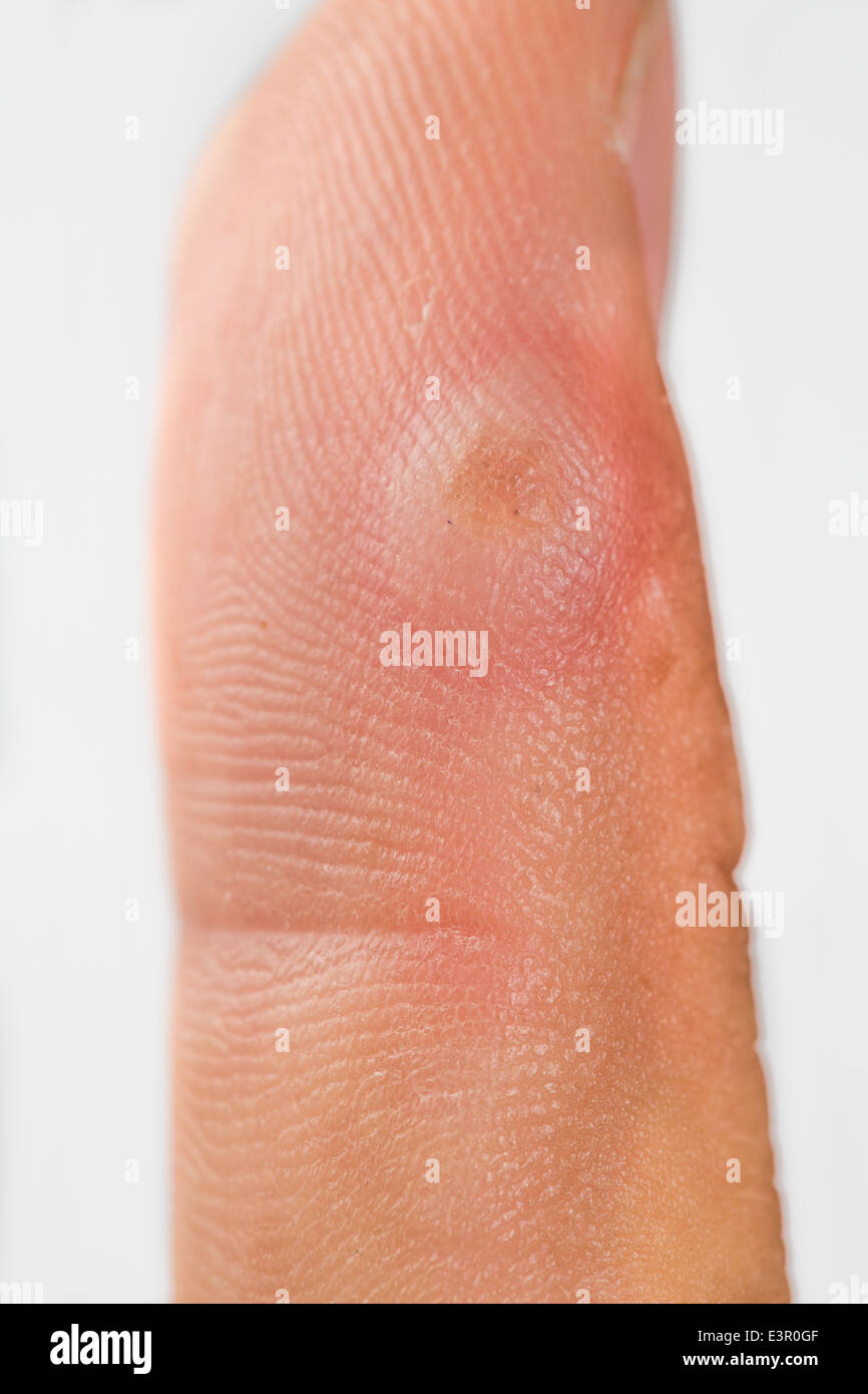 Bruciare le verruche immagini e fotografie stock ad alta risoluzione ...