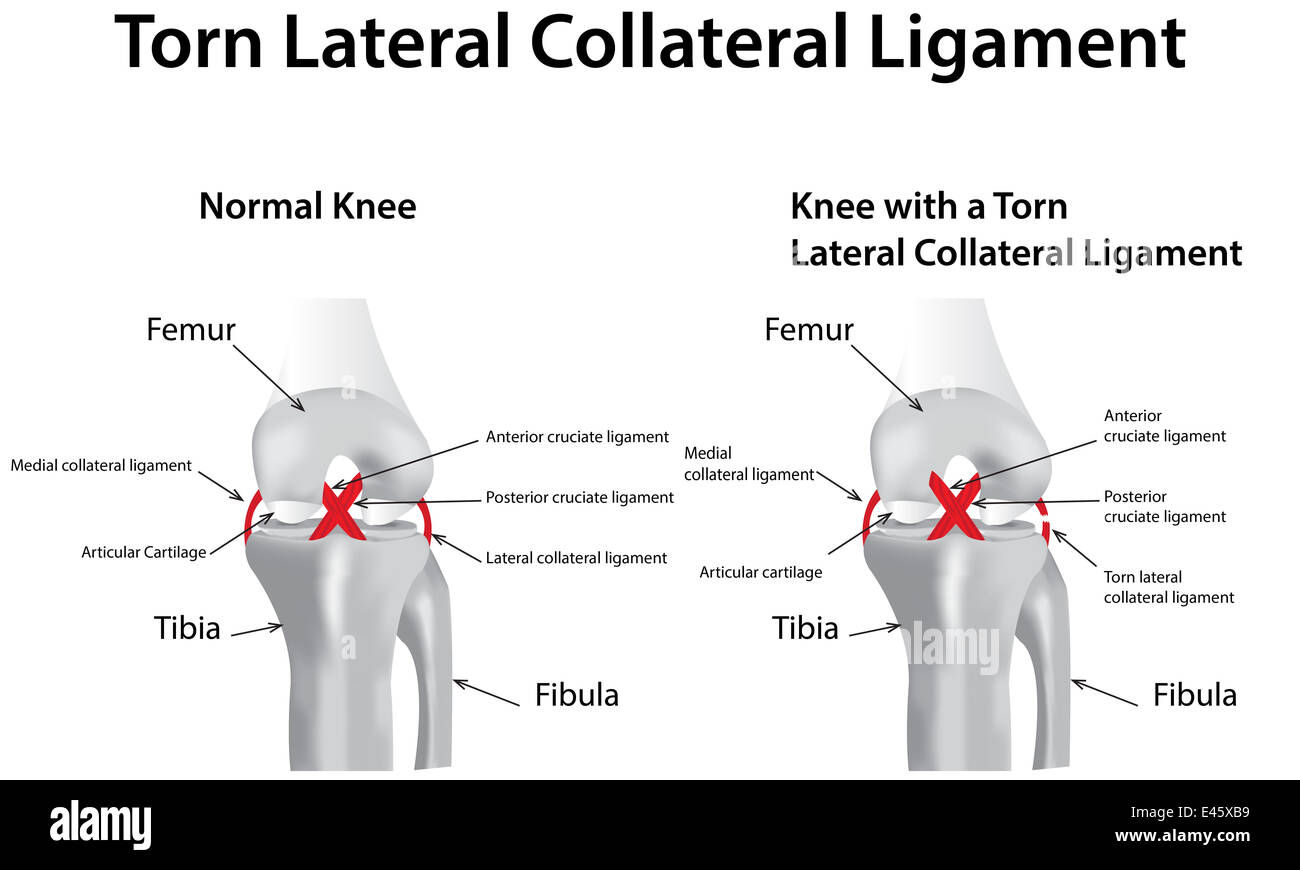 Legamento laterale immagini e fotografie stock ad alta risoluzione - Alamy