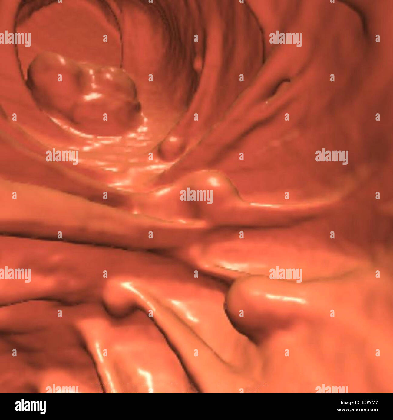Poliposi del colon immagini e fotografie stock ad alta risoluzione - Alamy