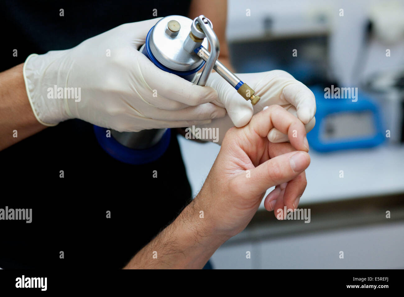 Il dermatologo trattando una verruca con azoto liquido Foto stock - Alamy