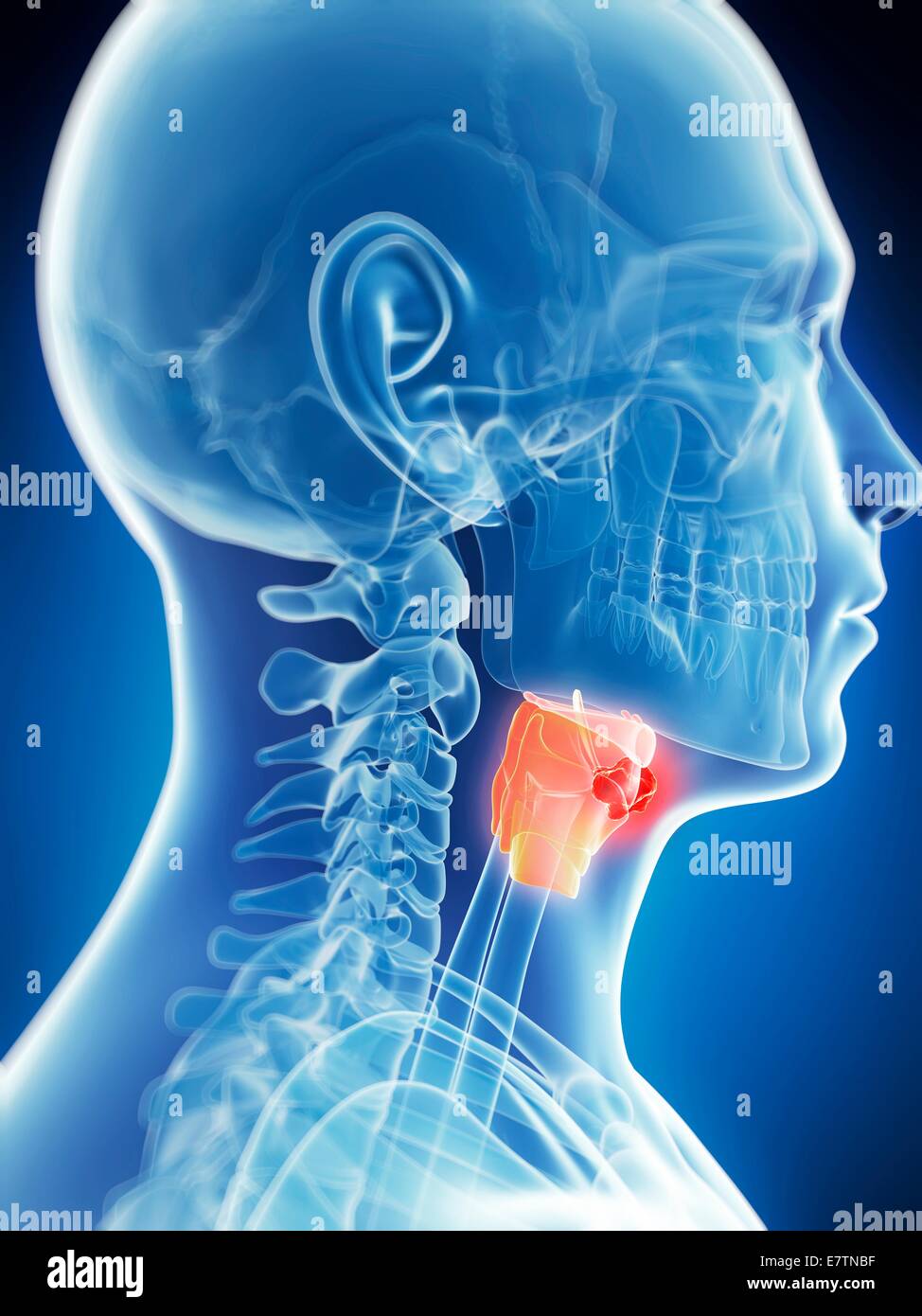 Cancro della laringe umano immagini e fotografie stock ad alta ...
