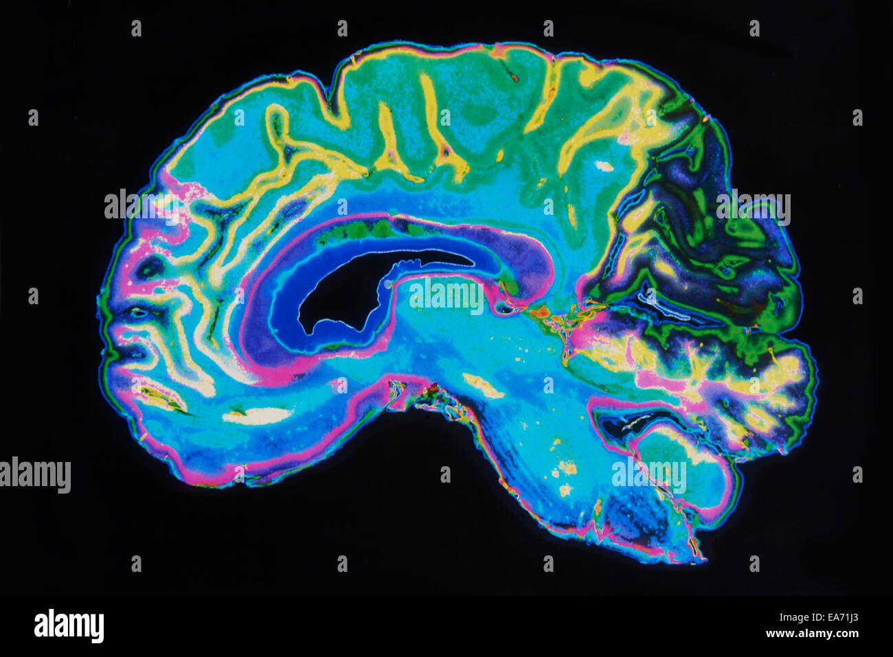 Mri scan brain immagini e fotografie stock ad alta risoluzione - Alamy