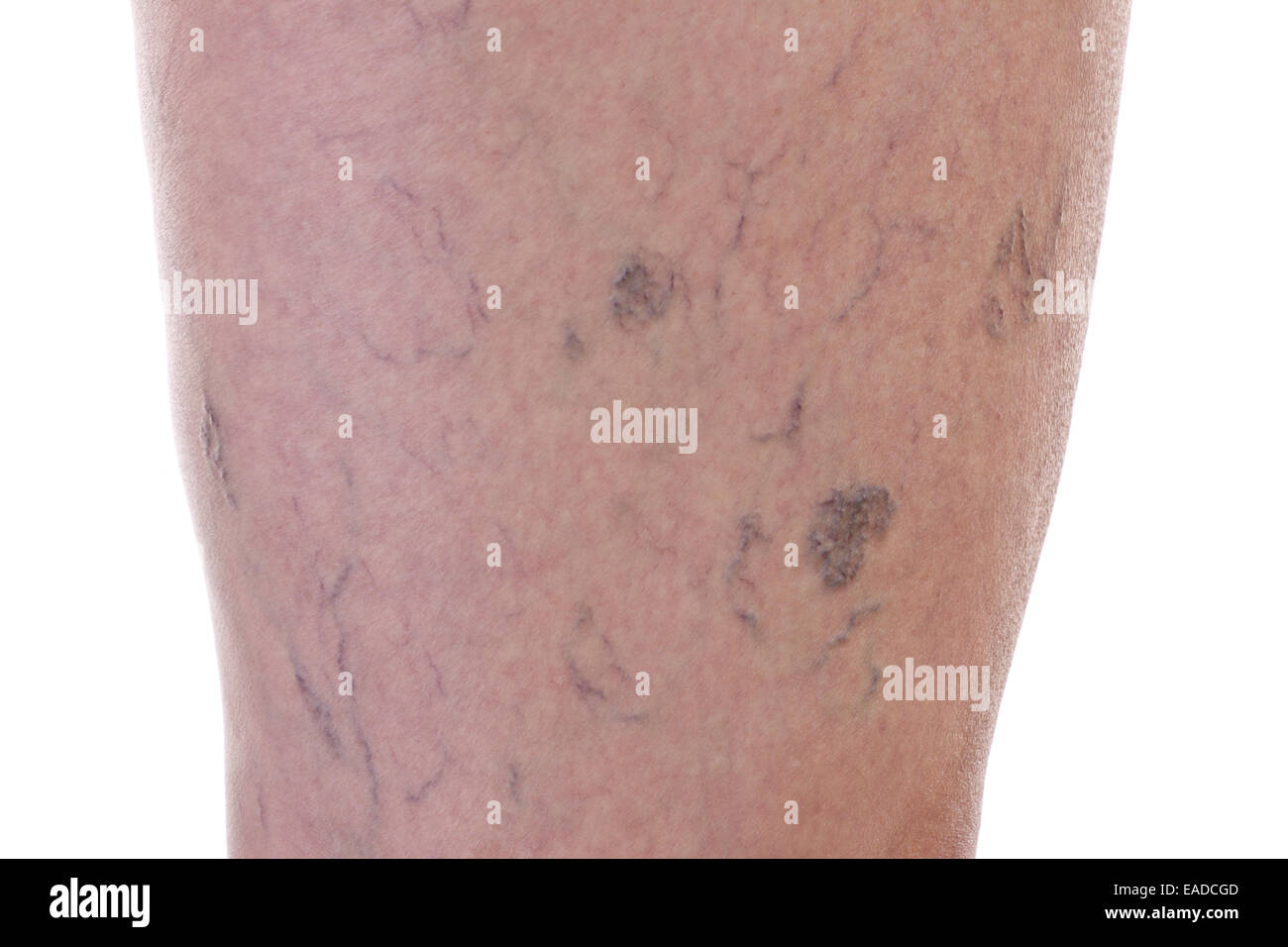 Trombosi delle vene delle gambe immagini e fotografie stock ad alta ...