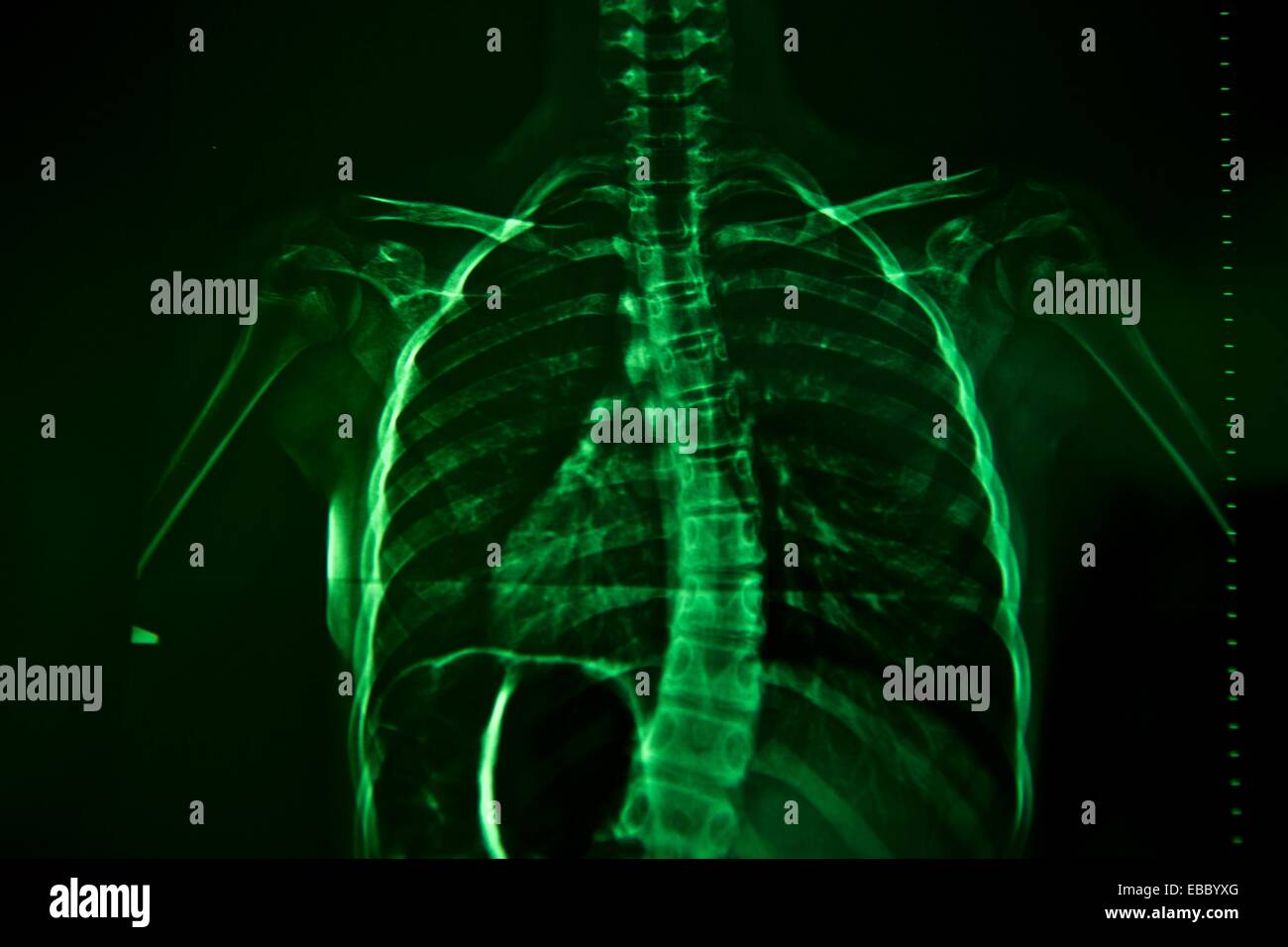 Scoliosi radiografia immagini e fotografie stock ad alta risoluzione ...