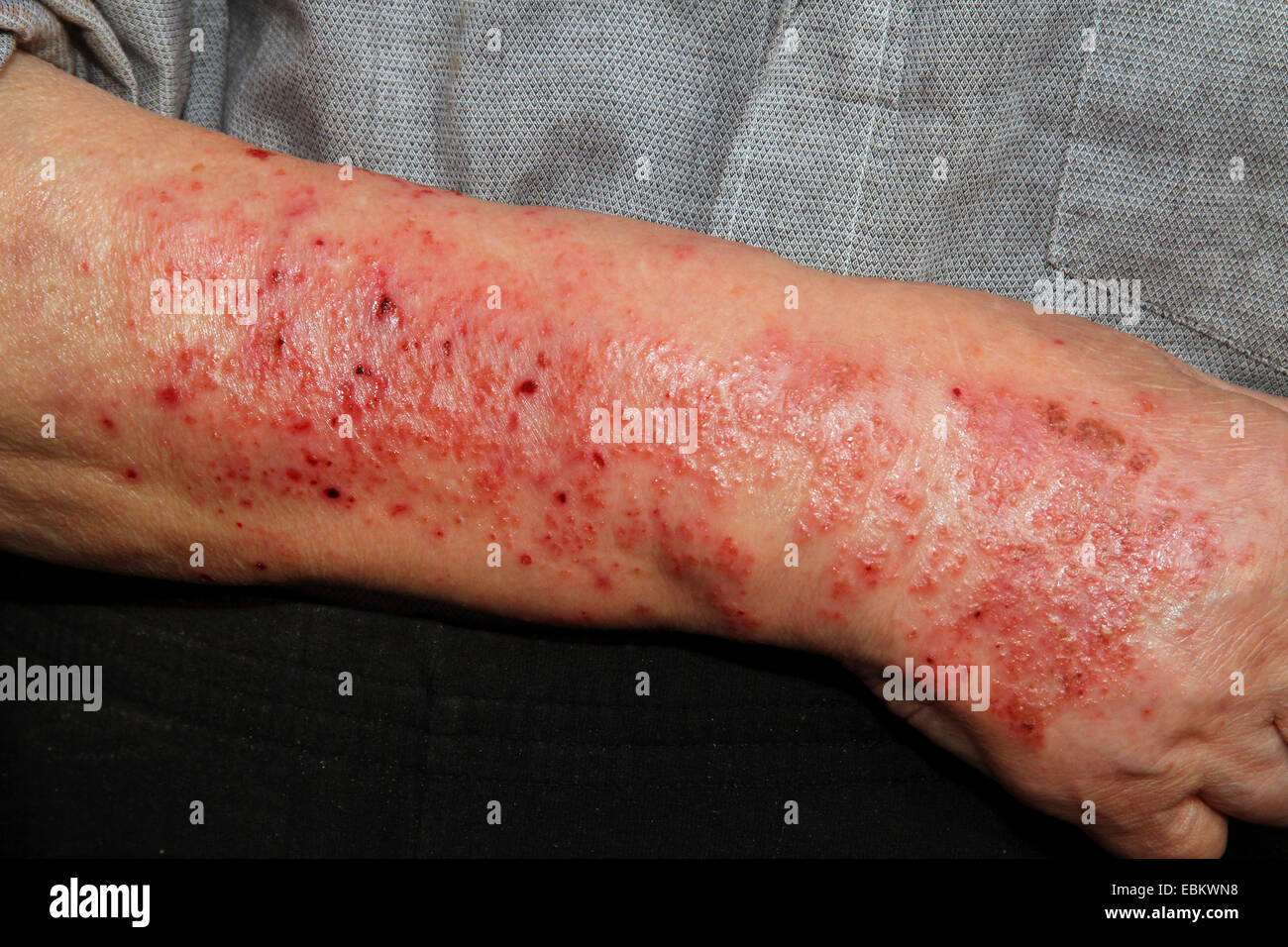 Dermatitis allergic not plant immagini e fotografie stock ad alta ...
