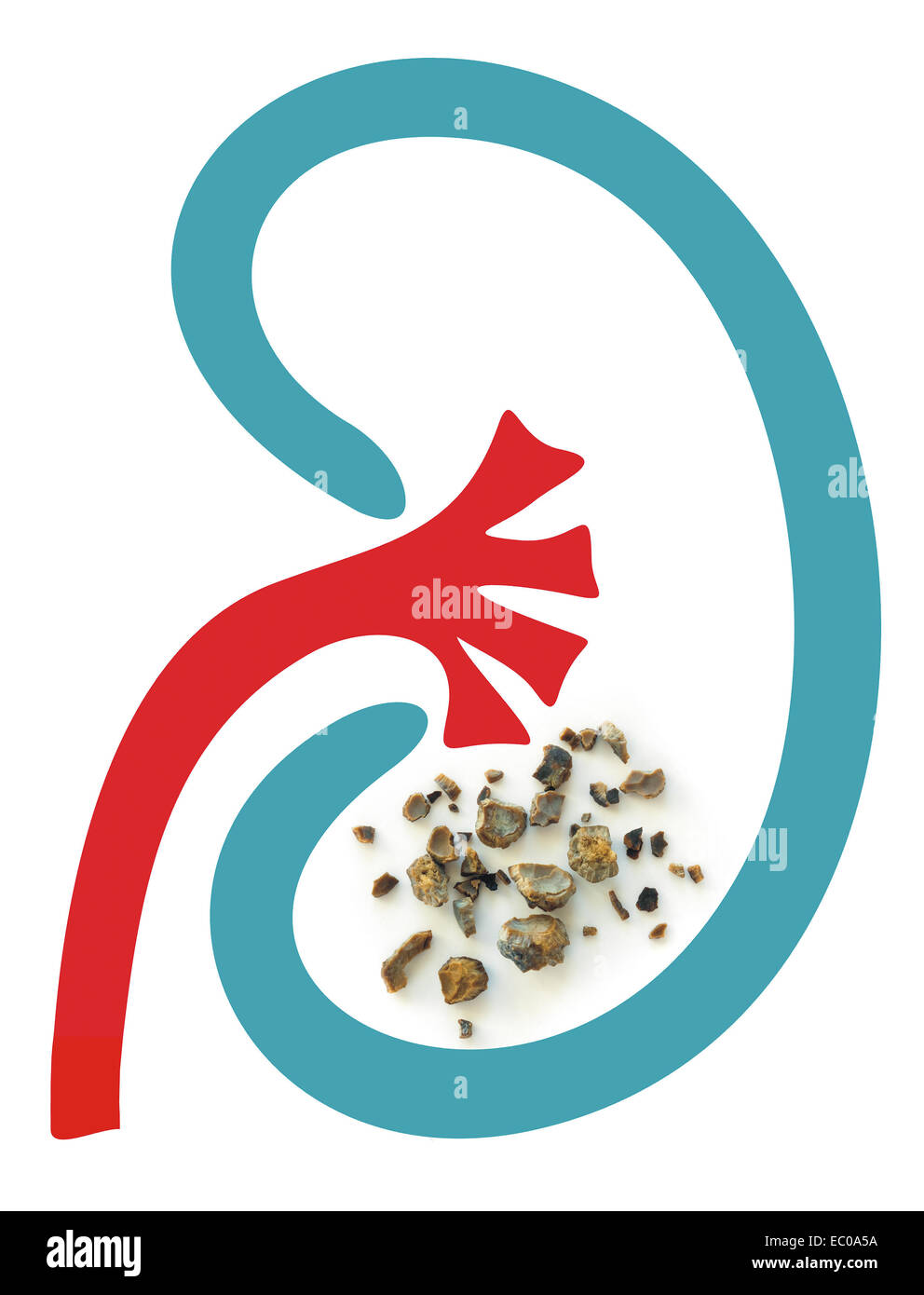 Calcoli renali immagini e fotografie stock ad alta risoluzione - Alamy