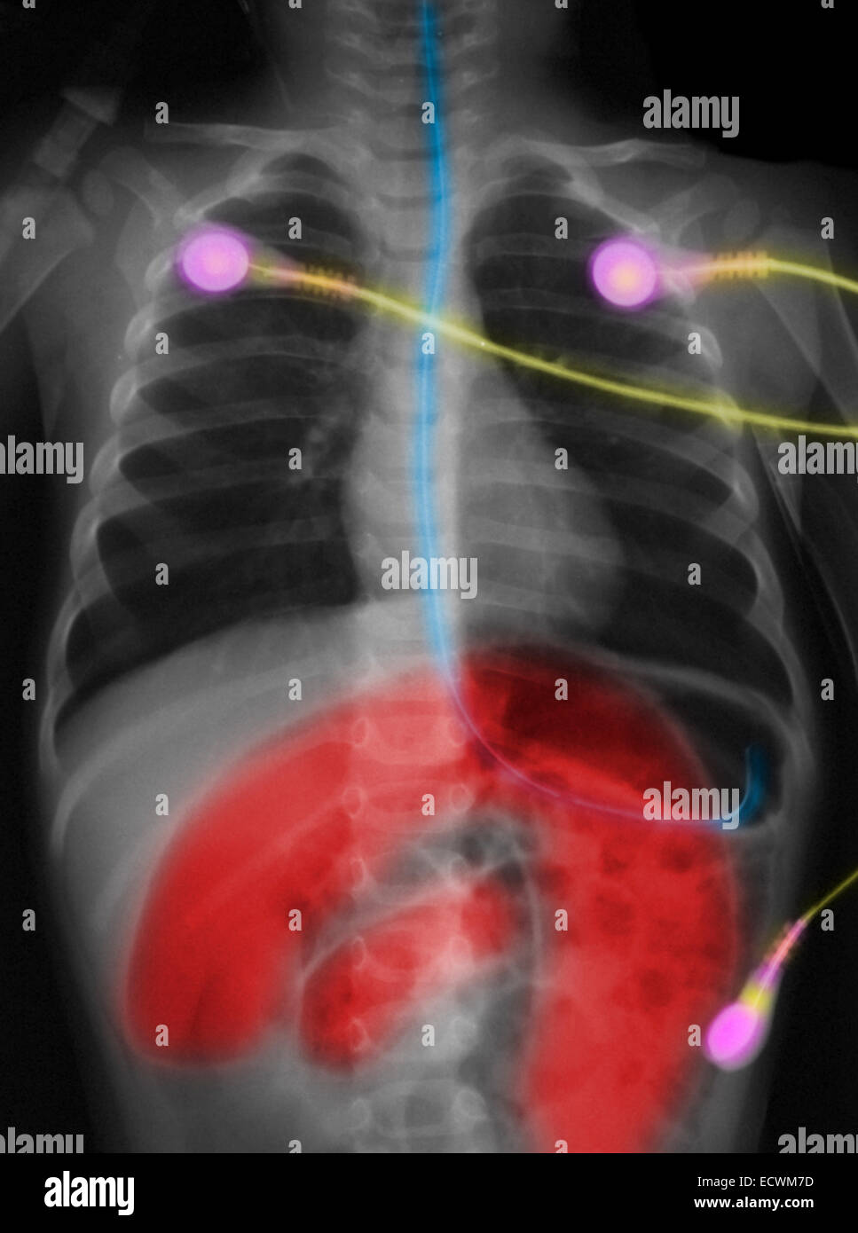 I raggi x al torace di un undici mesi con Hirschsprung della malattia ...