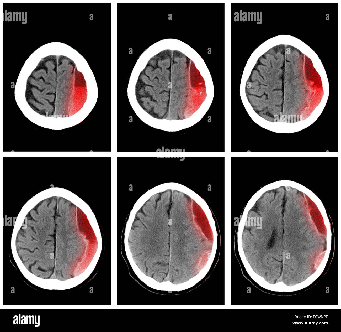 Ct scan head subdural hematoma immagini e fotografie stock ad alta ...