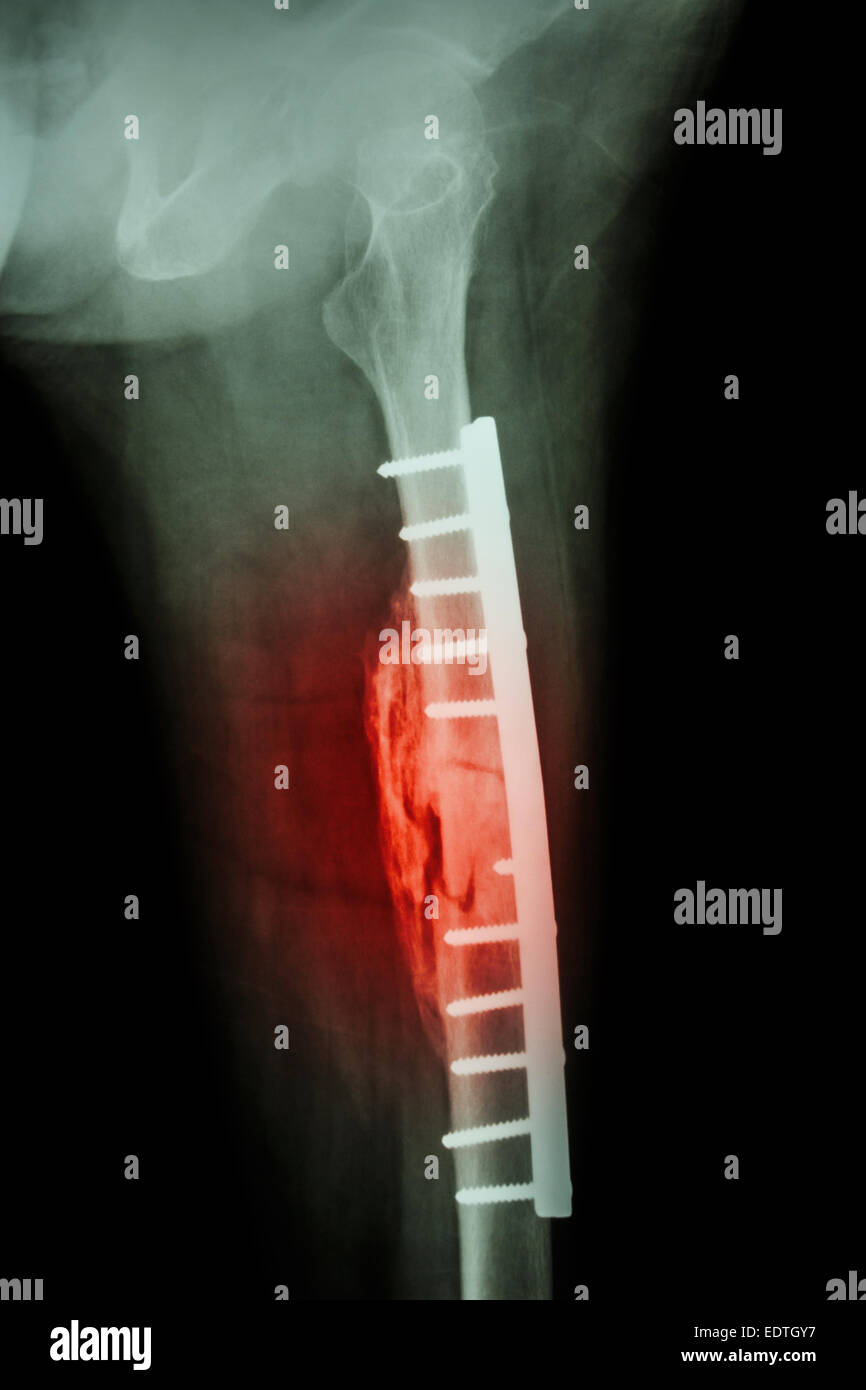 Frattura del femore immagini e fotografie stock ad alta risoluzione - Alamy