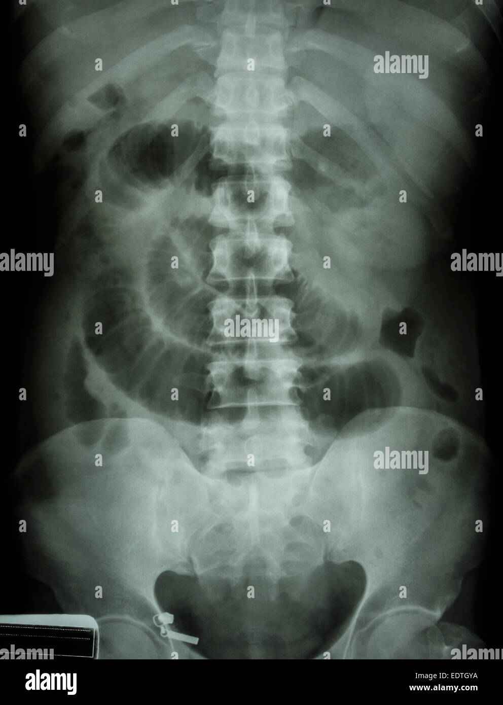 Anatomia del piccolo intestino immagini e fotografie stock ad alta ...