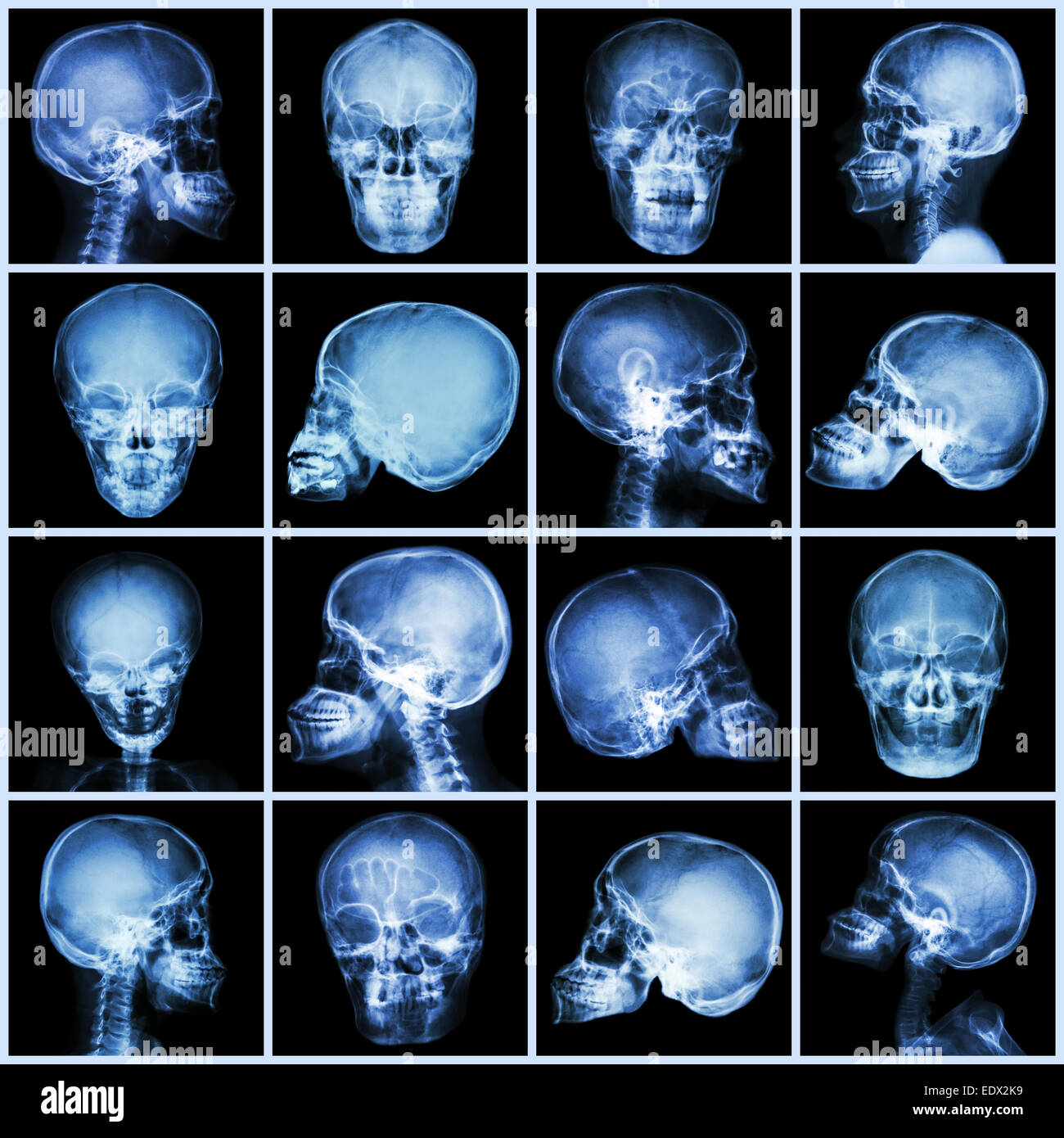 Neuro cranio immagini e fotografie stock ad alta risoluzione - Alamy