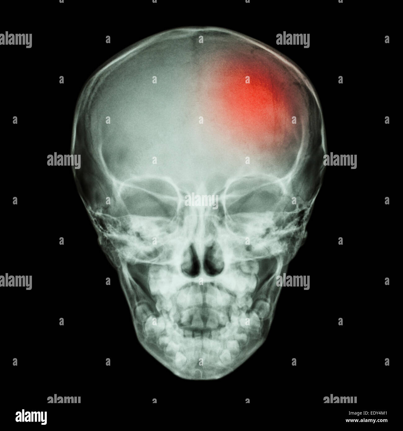 Cranio neonato anatomia immagini e fotografie stock ad alta risoluzione ...
