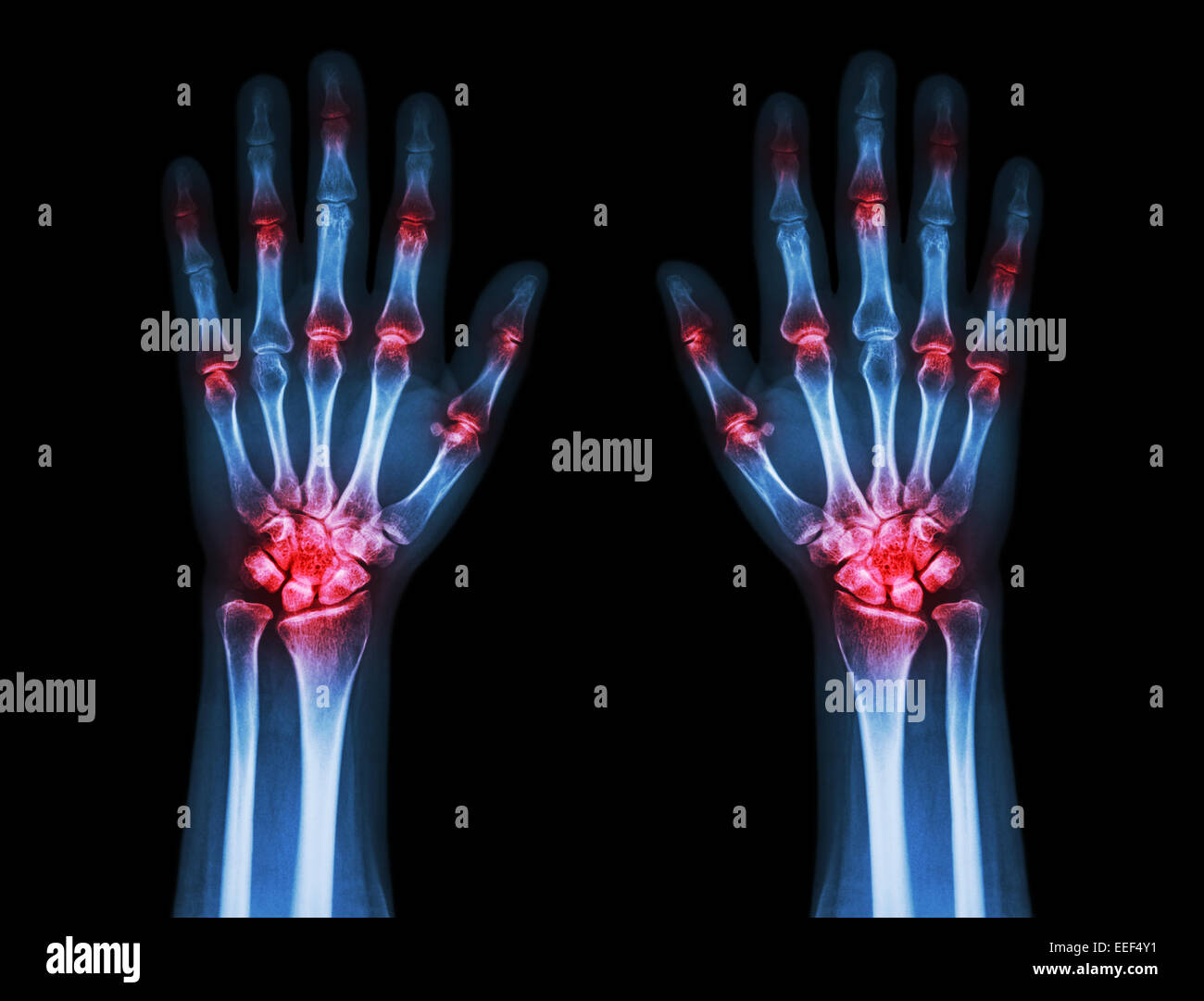 Artrite reumatoide della mano immagini e fotografie stock ad alta ...