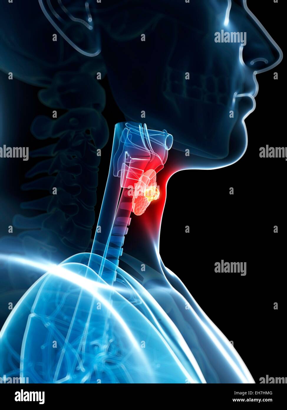 Larynx cancer immagini e fotografie stock ad alta risoluzione - Alamy