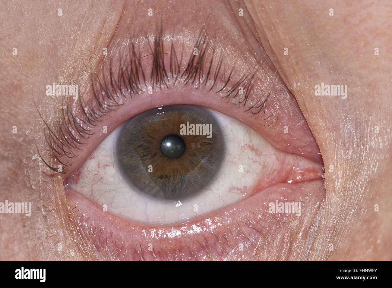Occhio di cataratta immagini e fotografie stock ad alta risoluzione - Alamy