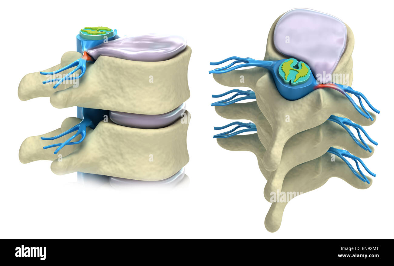Lesione del disco intervertebrale Immagini senza sfondo e Foto Stock ...