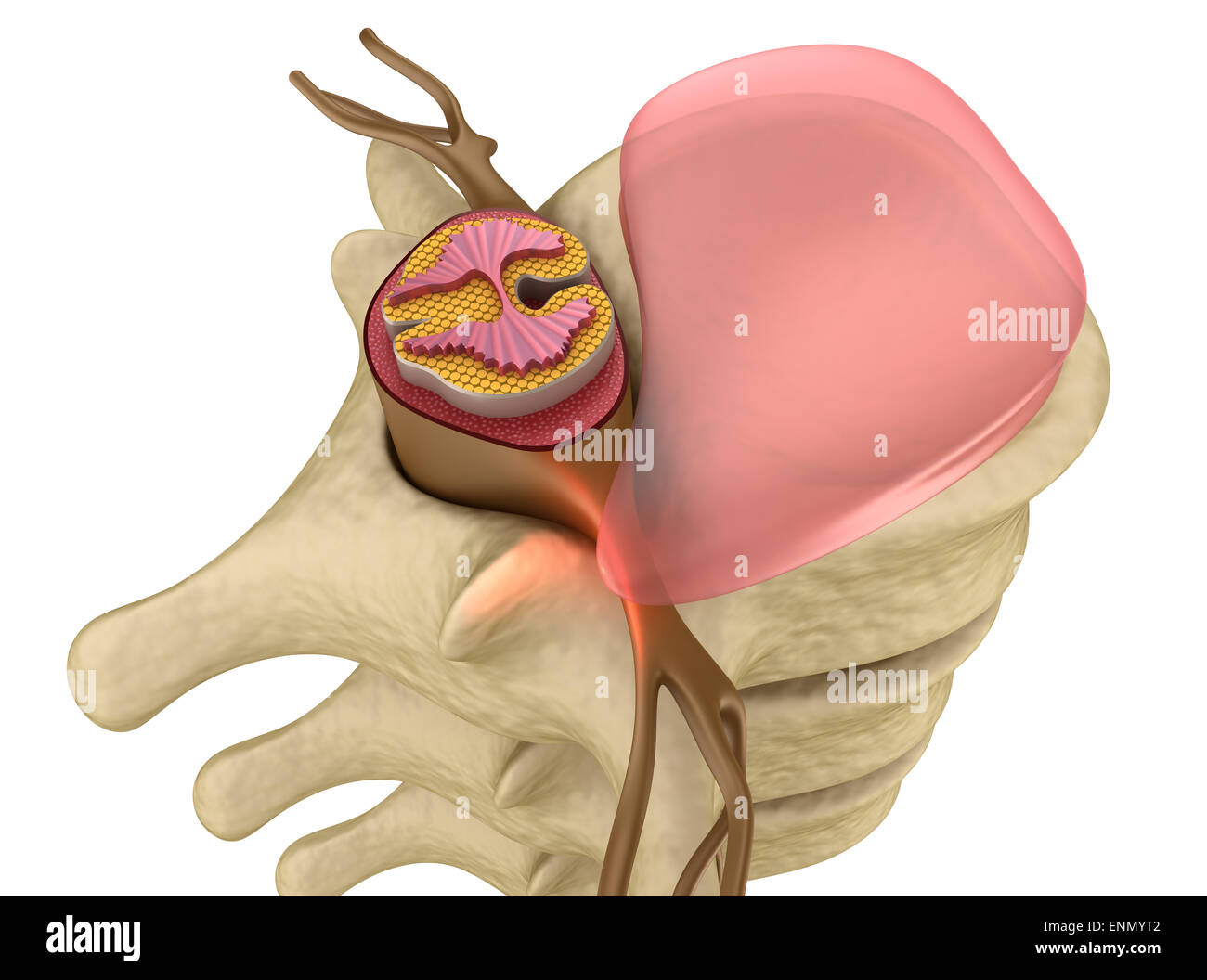 Disco intervertebrale scivolato immagini e fotografie stock ad alta ...