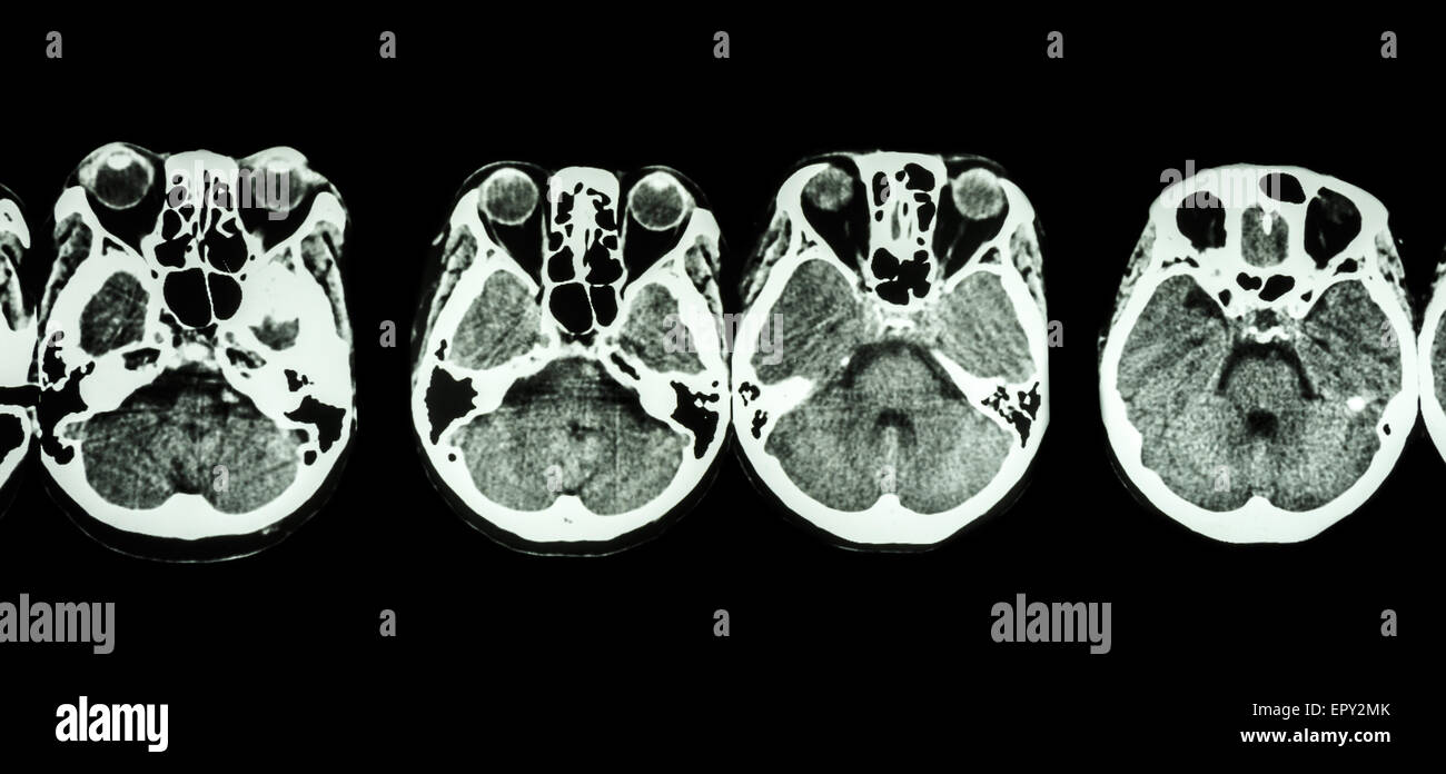 Struttura del cranio immagini e fotografie stock ad alta risoluzione ...
