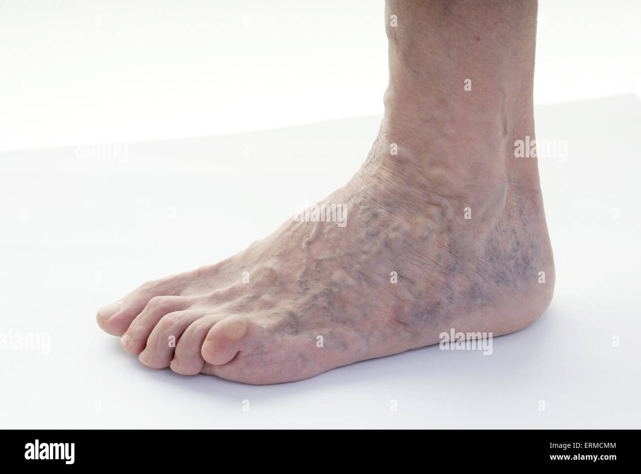 Vene varicose gamba (femmine, età 68 anni) / Krampfadern Varizen am ...