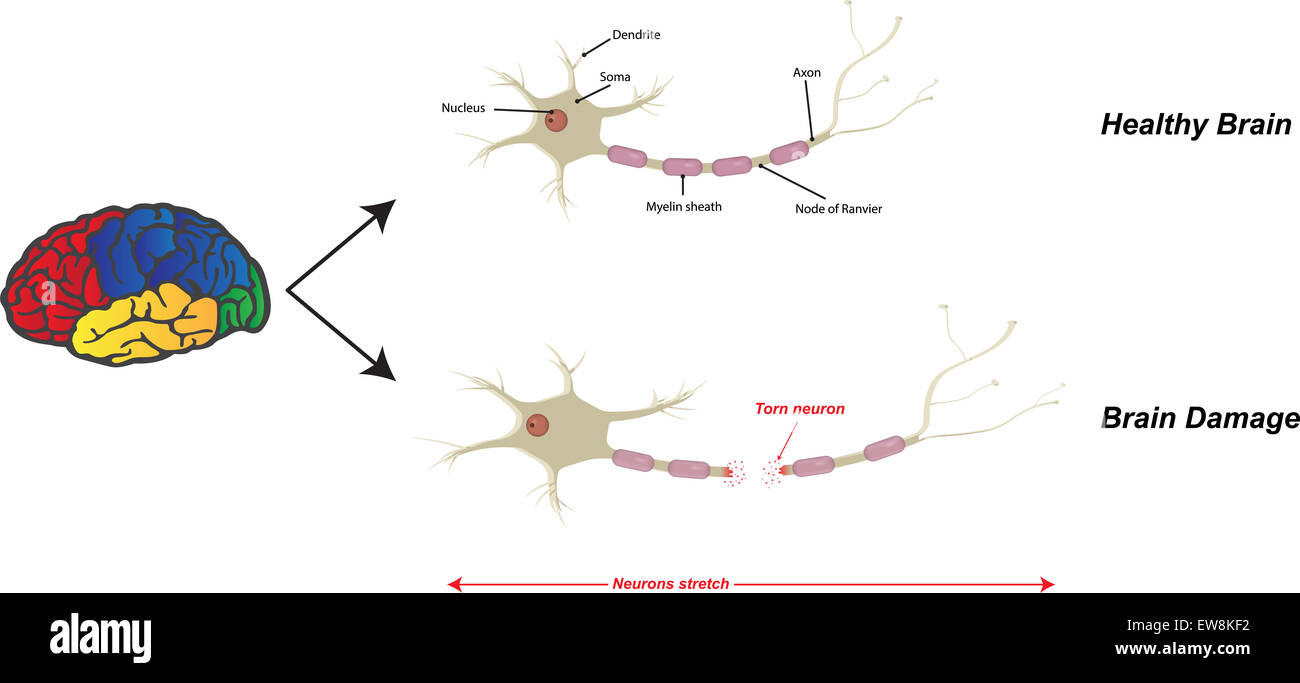 Danni ai nervi immagini e fotografie stock ad alta risoluzione - Alamy