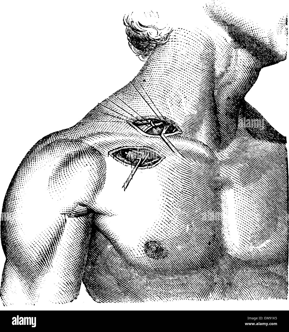 Brachial artery immagini e fotografie stock ad alta risoluzione - Alamy