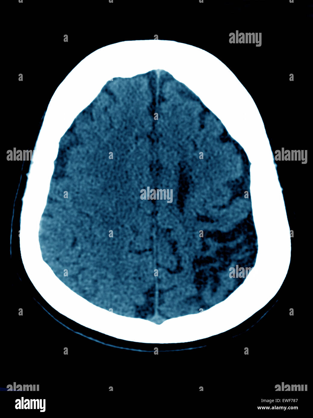 Atrofia cerebrale, TC-SCAN Foto stock - Alamy