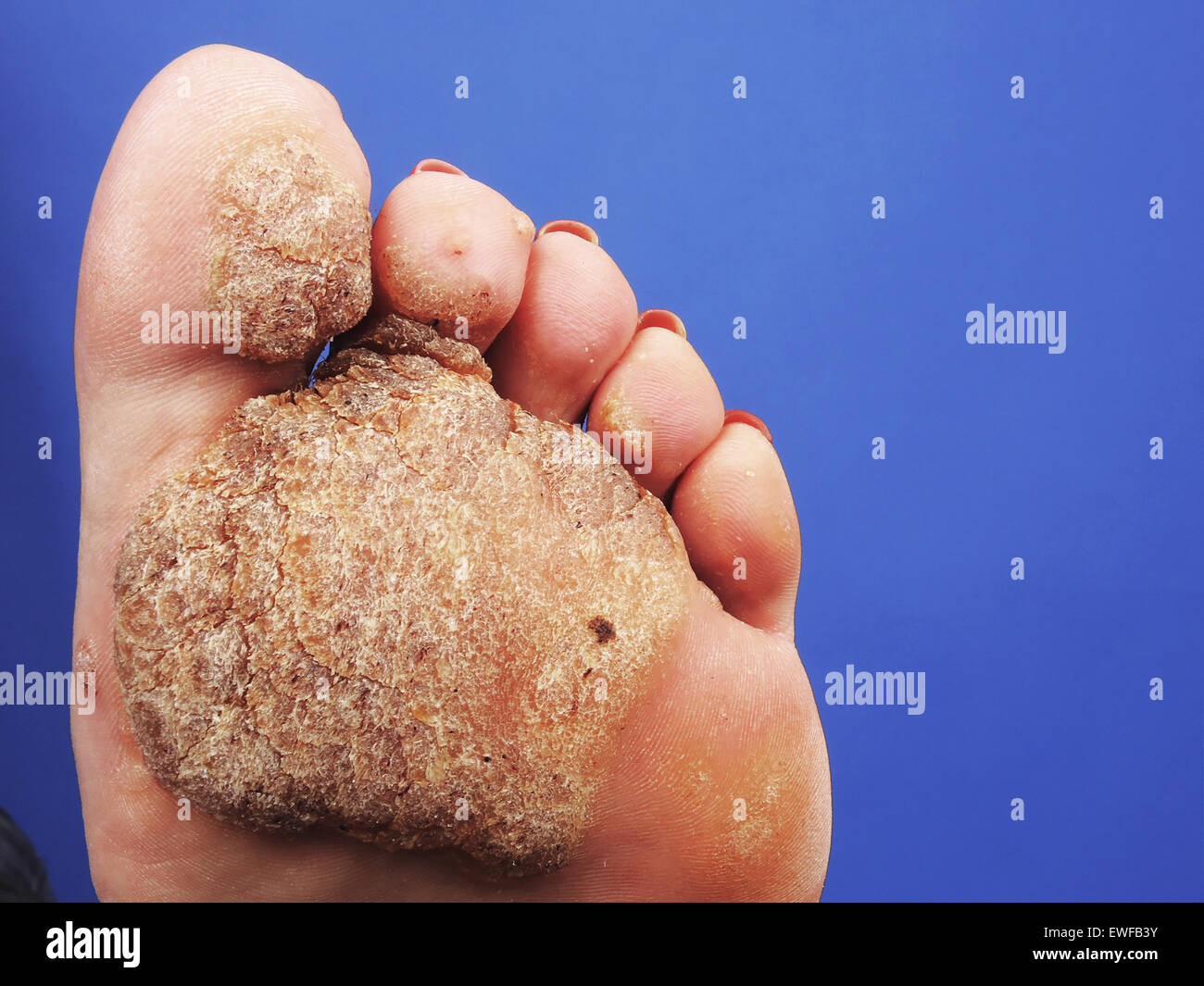 Verruca del piede immagini e fotografie stock ad alta risoluzione - Alamy