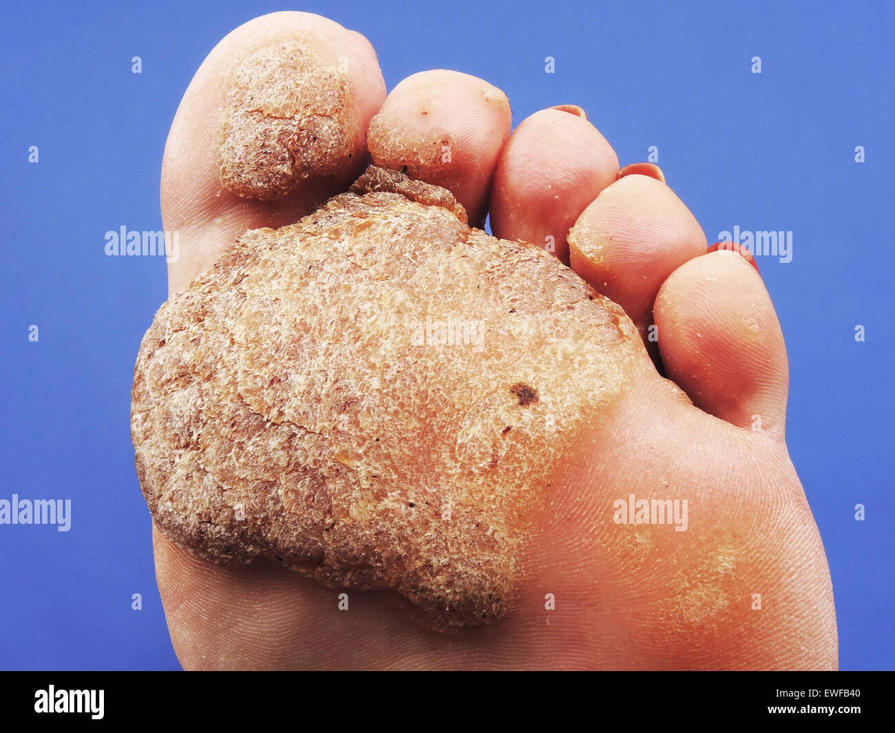 Verruca plantare immagini e fotografie stock ad alta risoluzione - Alamy