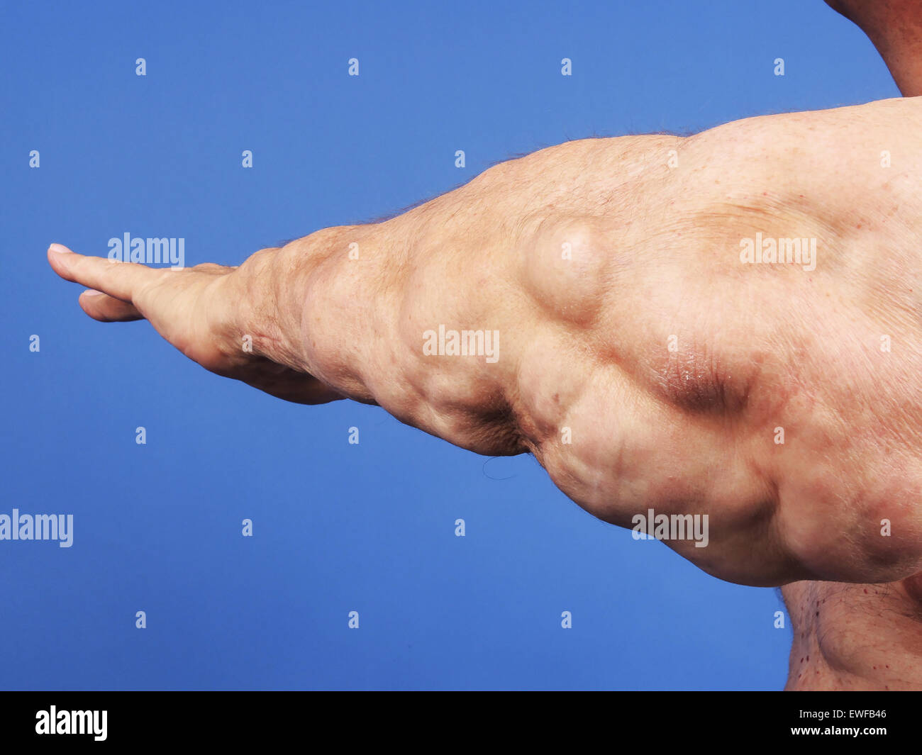 Lipoma tumour tumor immagini e fotografie stock ad alta risoluzione - Alamy