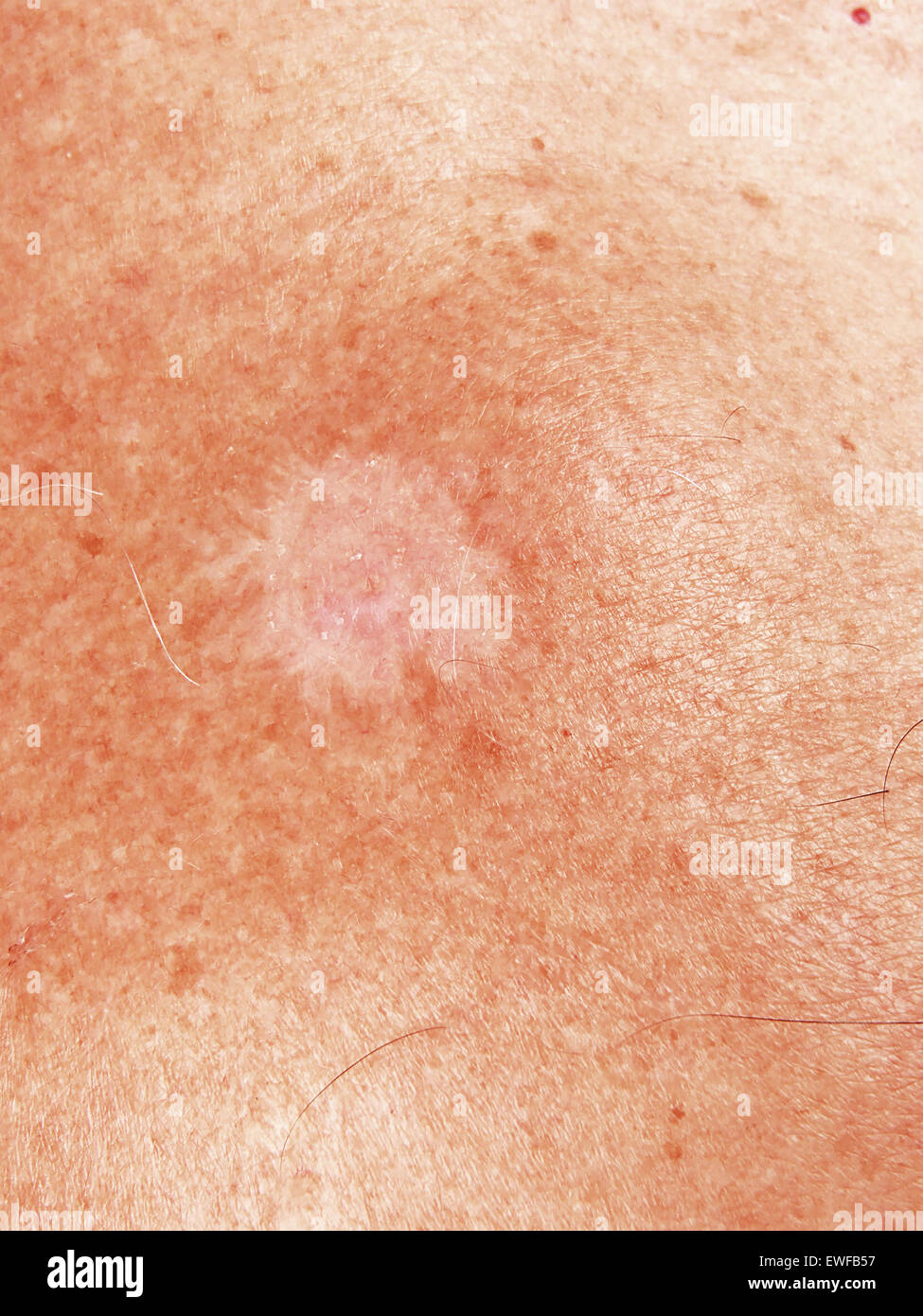 Basal cell carcinoma bcc immagini e fotografie stock ad alta ...