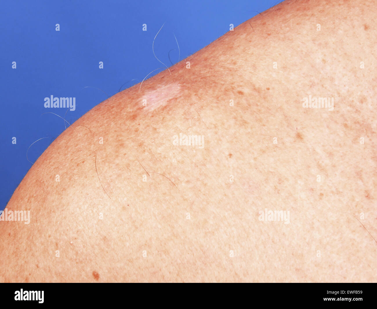 Basal cell carcinoma bcc immagini e fotografie stock ad alta ...