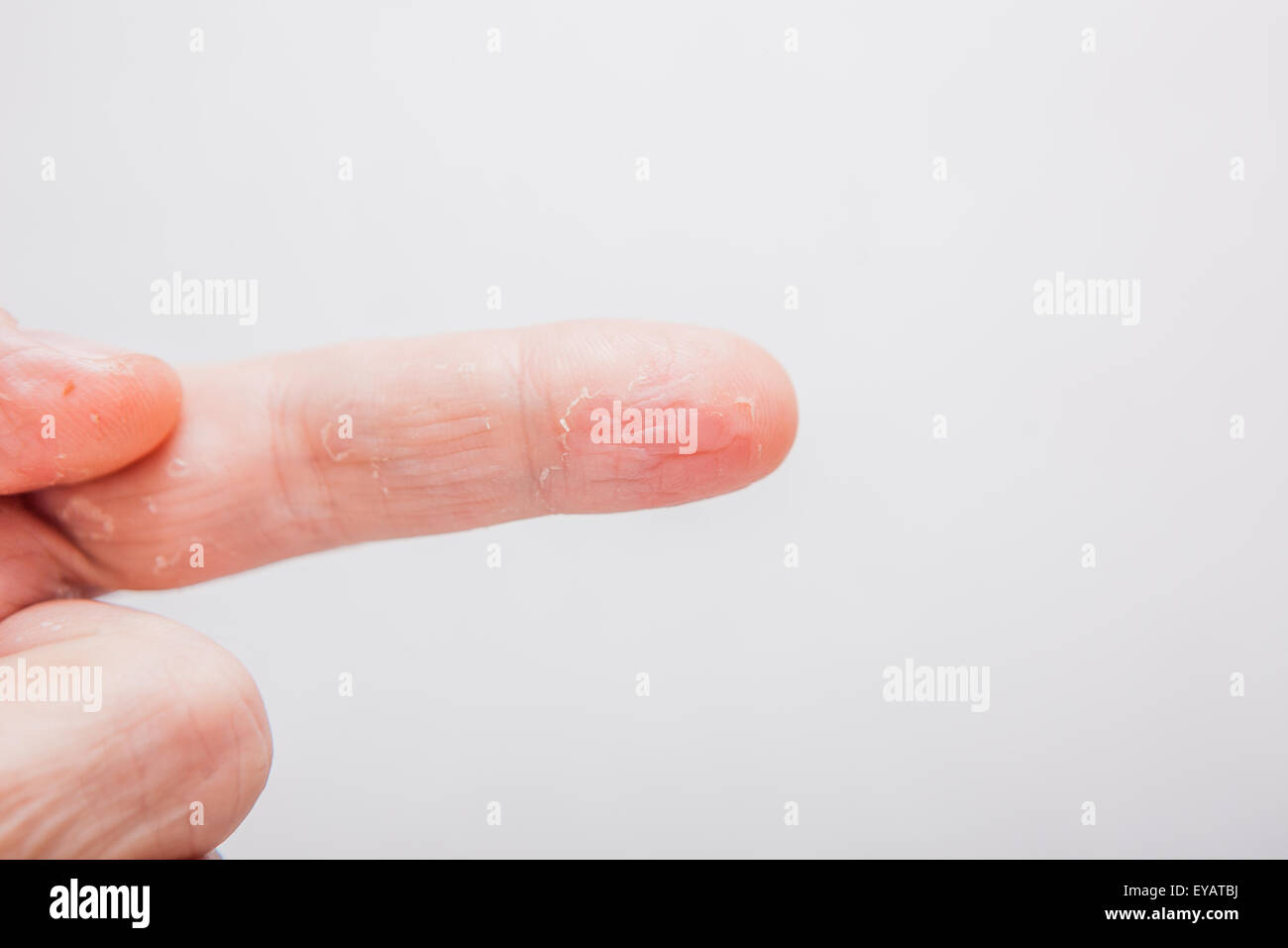 Eczema atopic dermatitis symptom skin immagini e fotografie stock ad ...