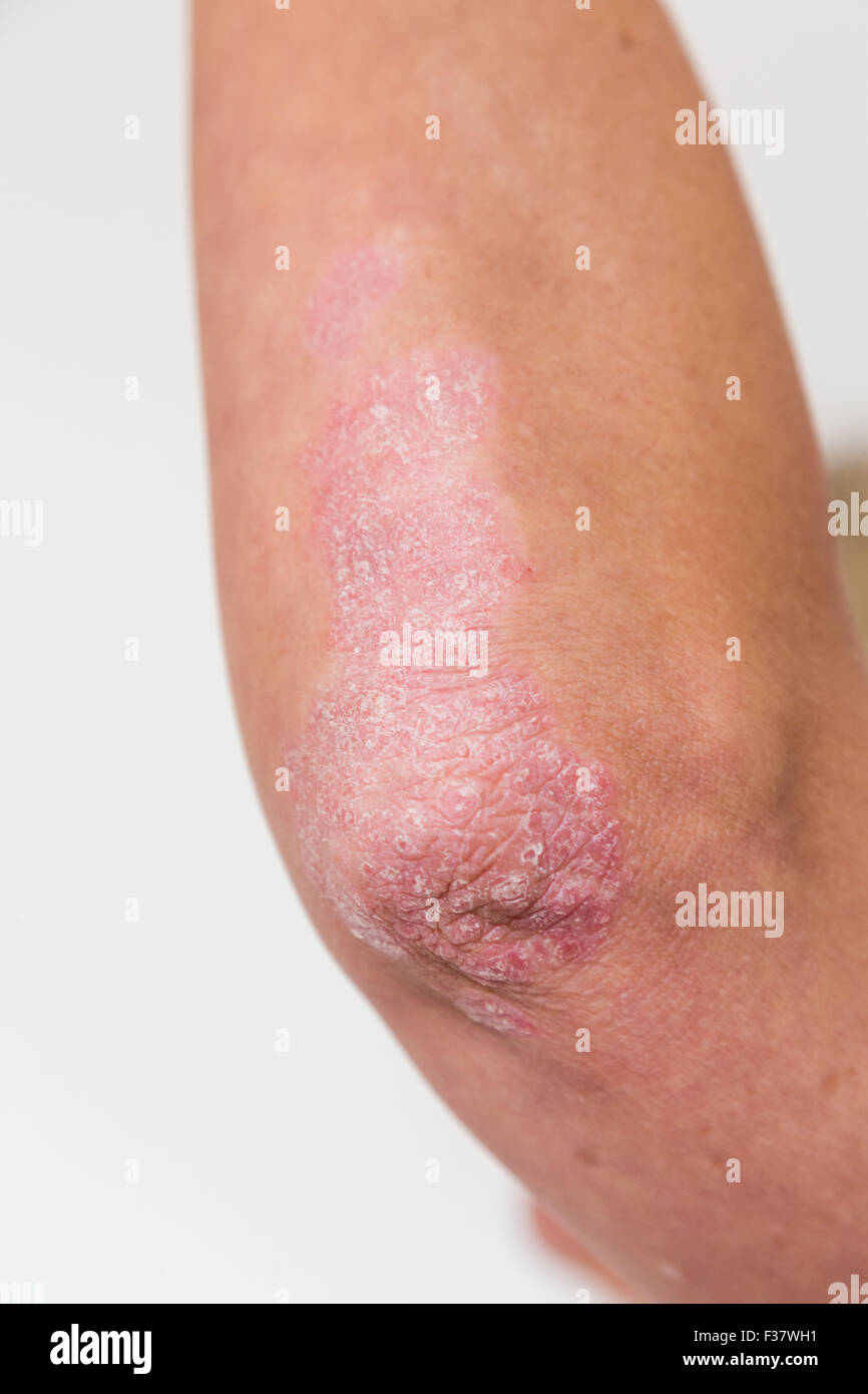 Psoriasi della malattia immagini e fotografie stock ad alta risoluzione ...