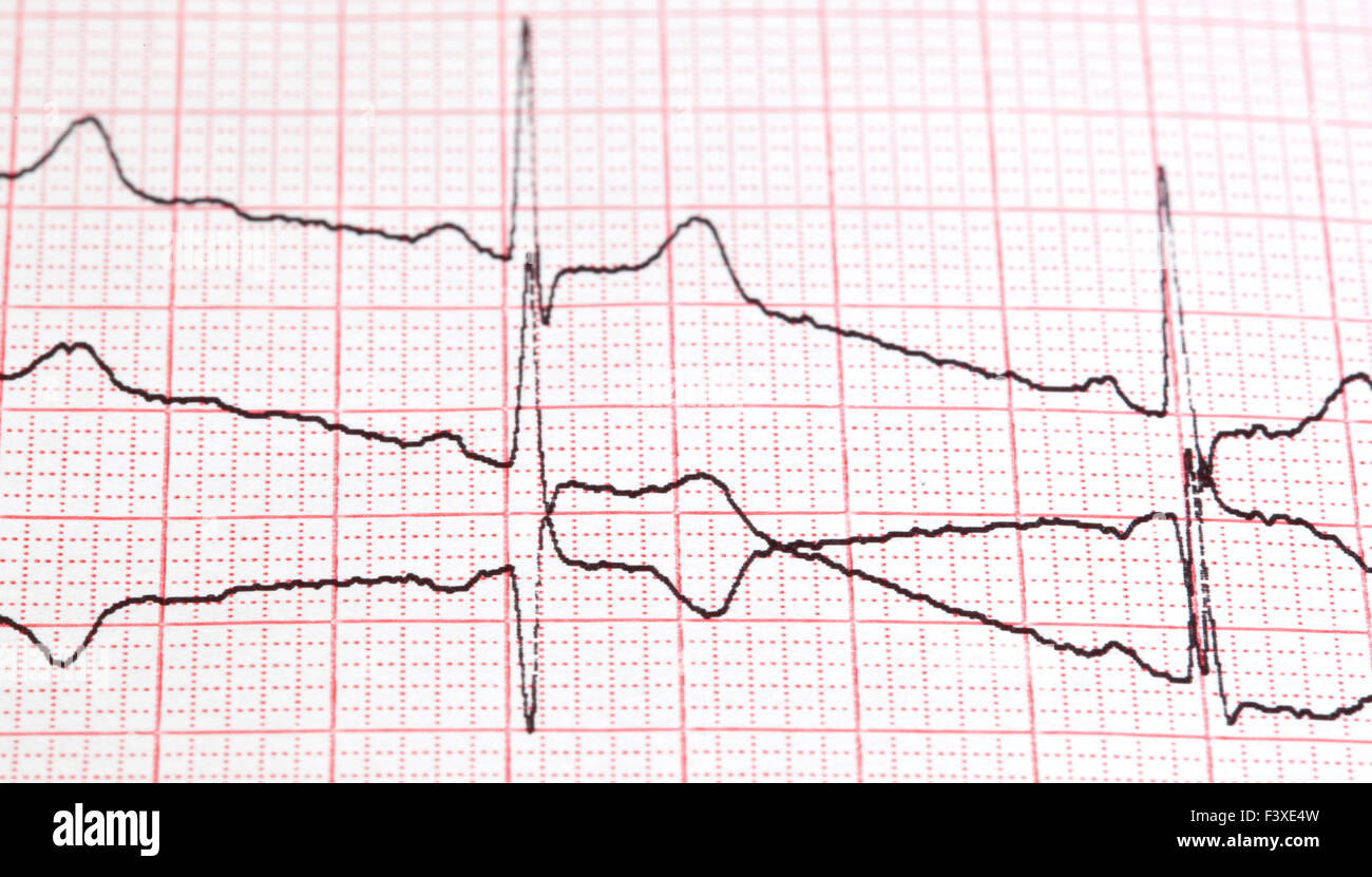 Coronary sinus immagini e fotografie stock ad alta risoluzione - Alamy