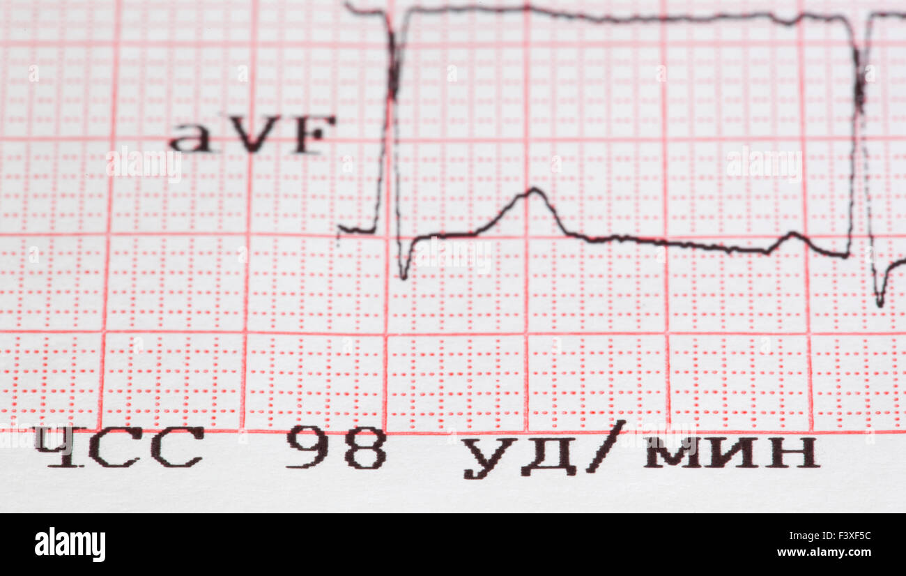 Coronary sinus immagini e fotografie stock ad alta risoluzione - Alamy