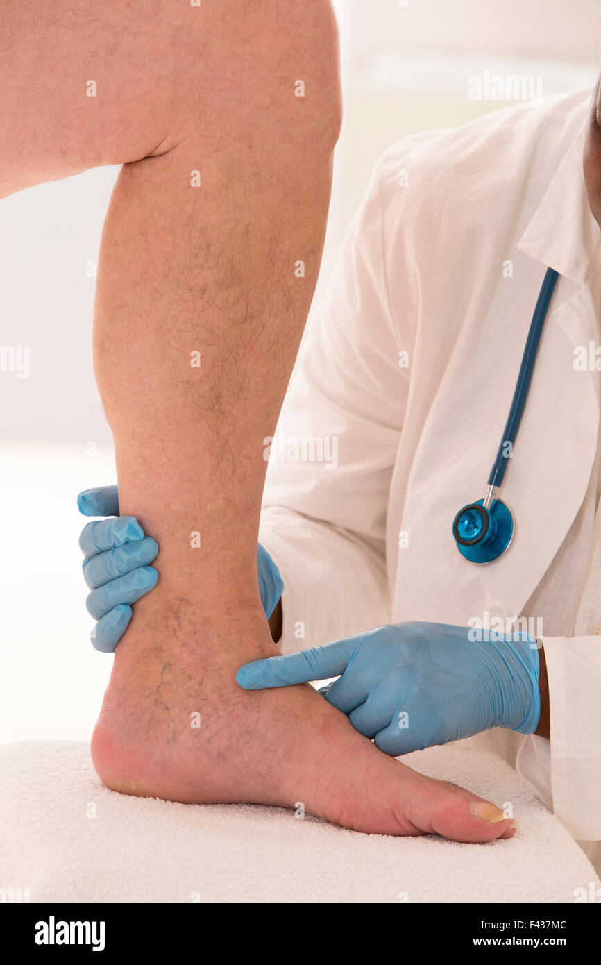 Varicose vein immagini e fotografie stock ad alta risoluzione - Alamy