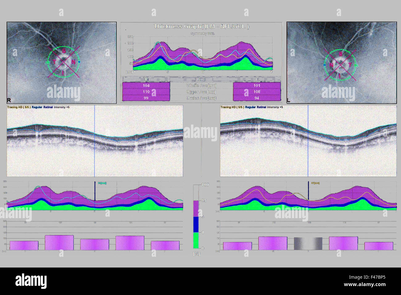 Tomografia a coerenza ottica immagini e fotografie stock ad alta risoluzione - Alamy