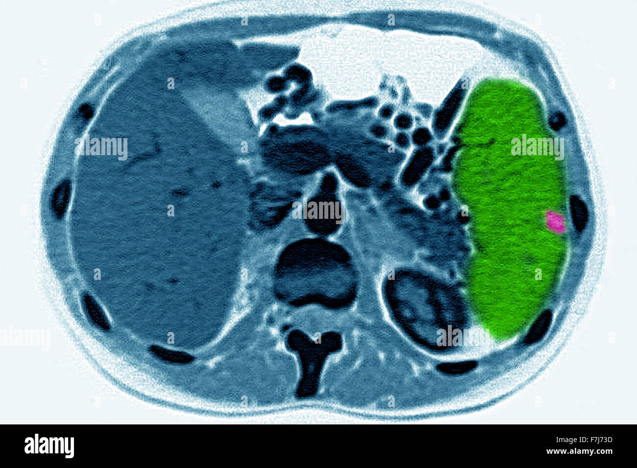 Milza di milza immagini e fotografie stock ad alta risoluzione - Alamy