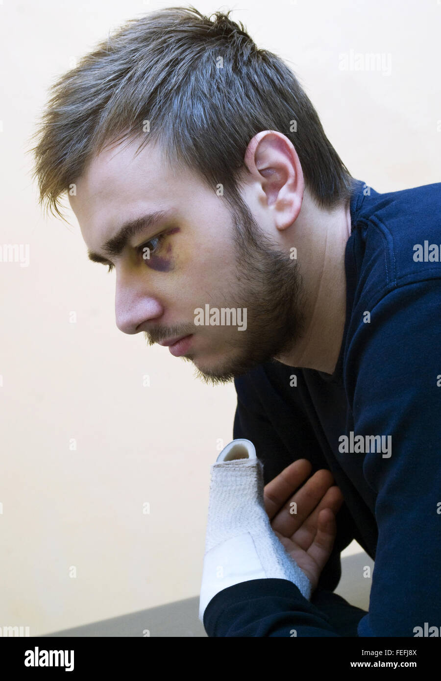 Livido nero immagini e fotografie stock ad alta risoluzione - Alamy