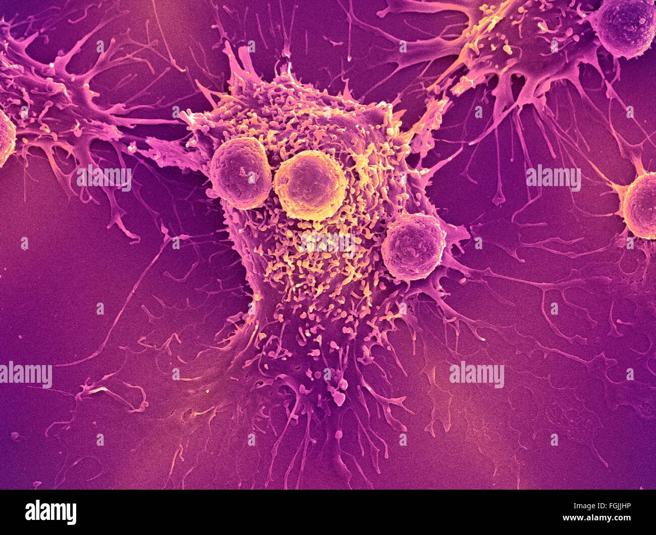 Linfociti T e cellule di cancro. Color scanning electron ...