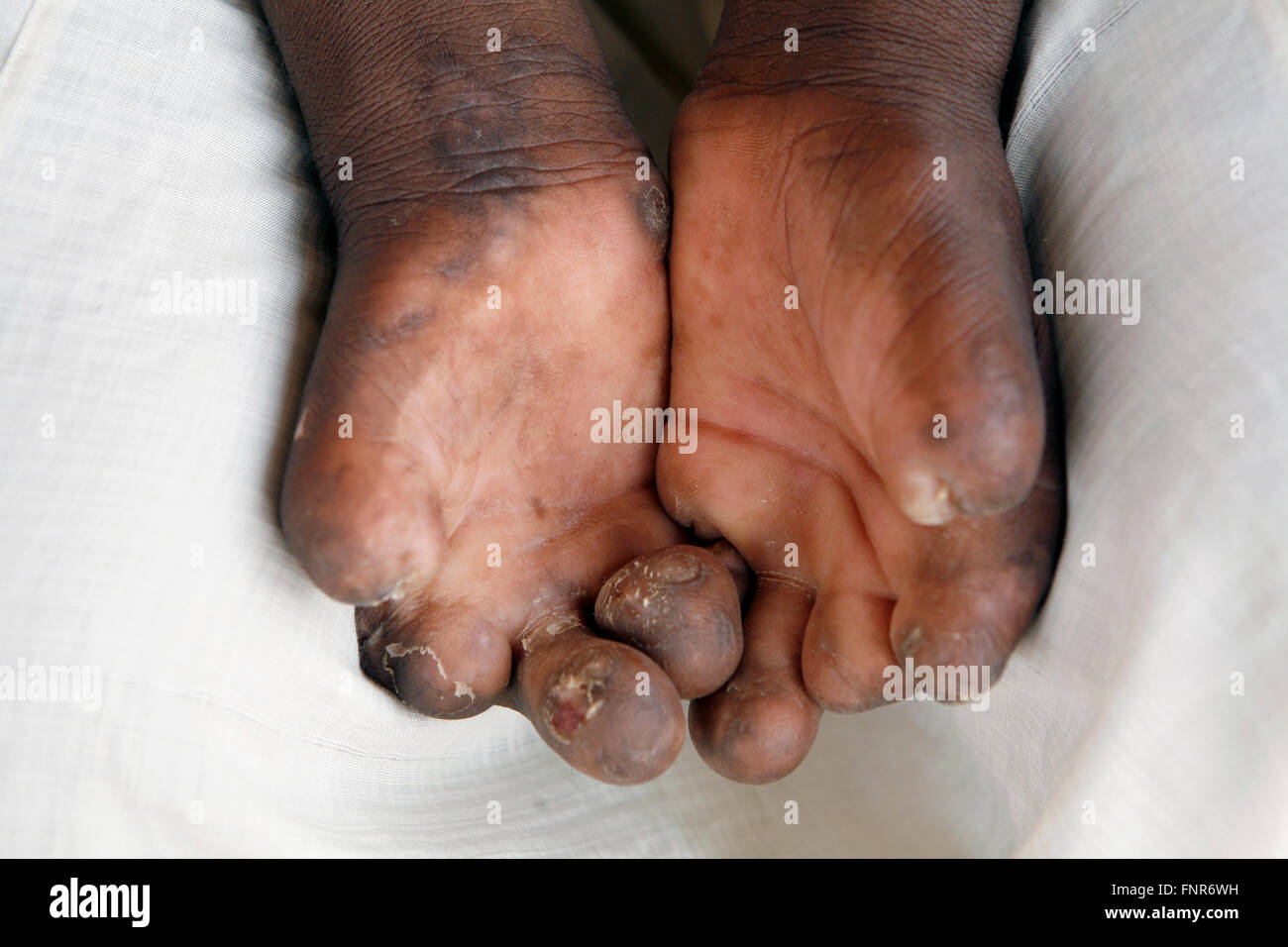 Malattia di lebbra immagini e fotografie stock ad alta risoluzione - Alamy