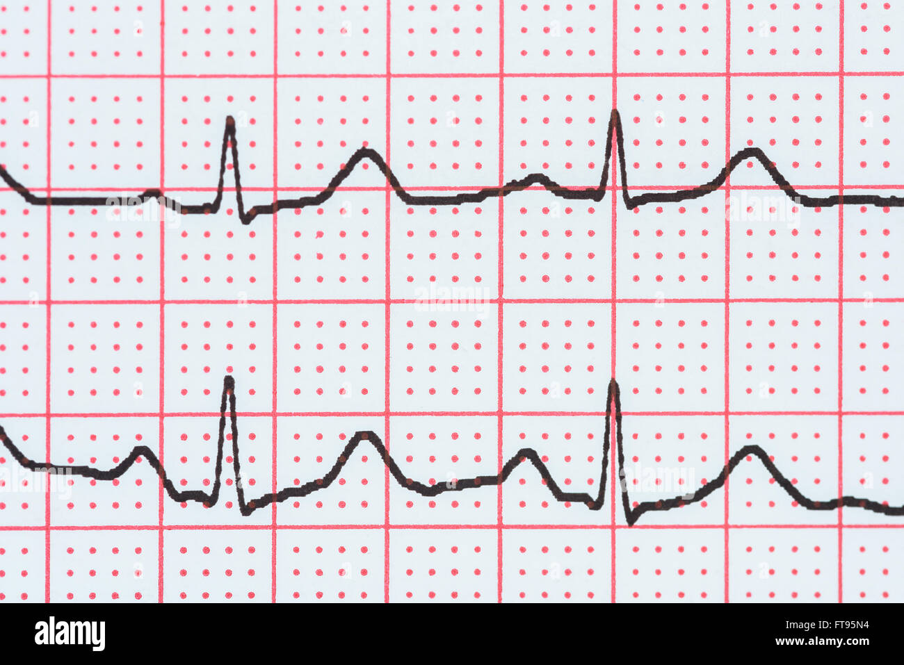 Tracciato ecg normale immagini e fotografie stock ad alta risoluzione ...