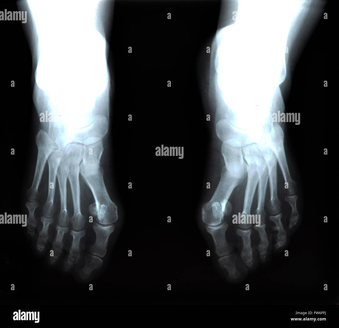 Radiografia del trauma immagini e fotografie stock ad alta risoluzione ...
